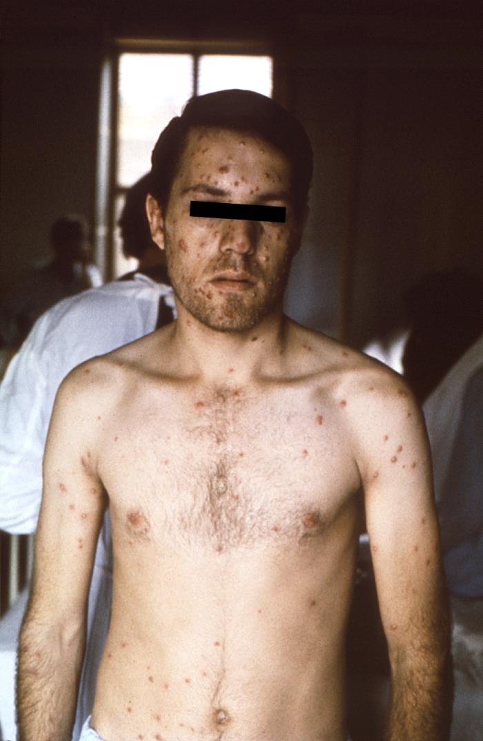 Details - Public Health Image Library(PHIL)