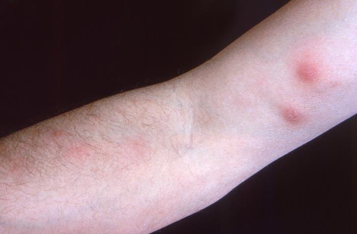 Details - Public Health Image Library(PHIL)